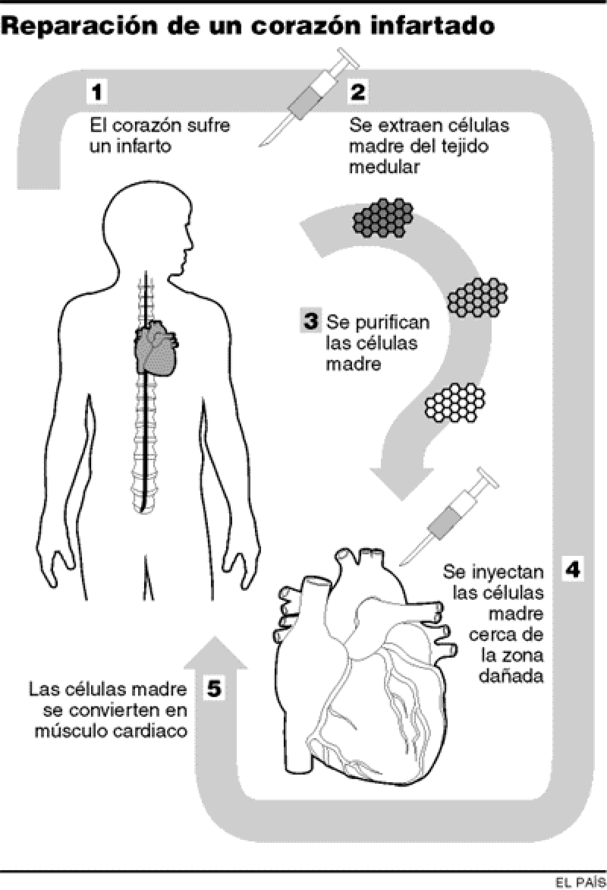 Reparación de un corazón infartado | Media | EL PAÍS