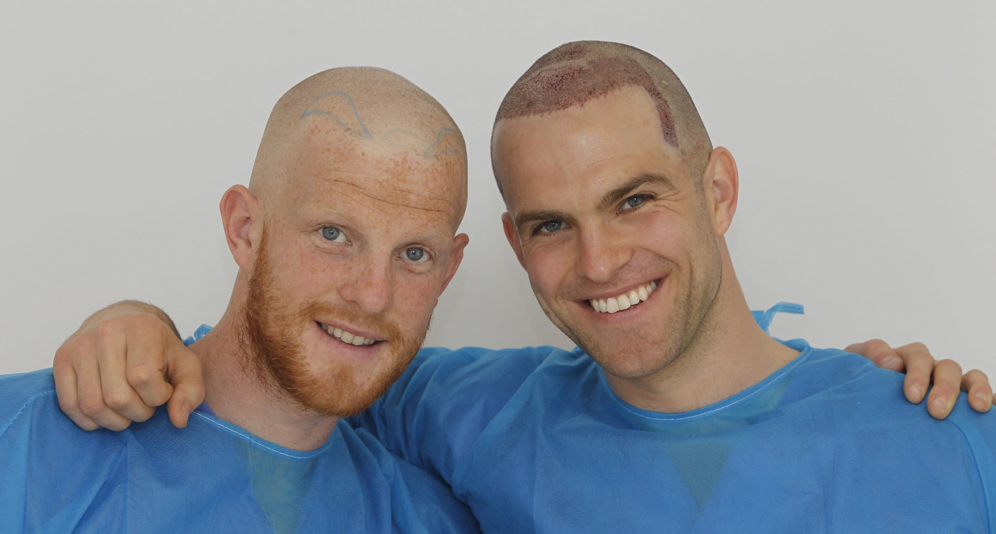 “No me resigno a ser calvo”: cómo el cabello se convirtió en la gran ...