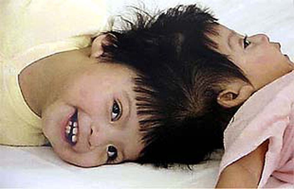 Comienza la primera de las operaciones para separar a dos siamesas ...