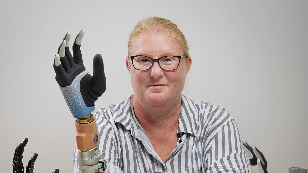 Tres años viviendo con una mano biónica: “Esta investigación me ha dado ...
