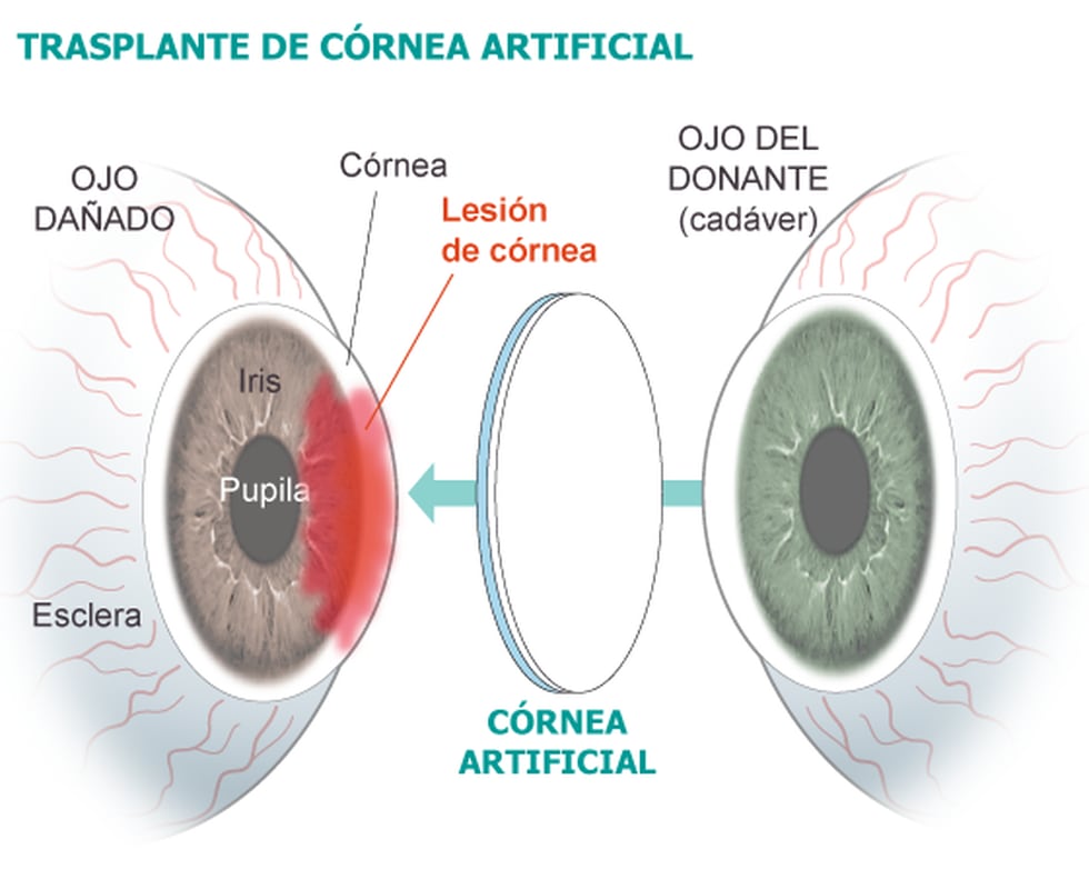 Implantada en Granada una novedosa córnea bioartificial | Noticias de ...