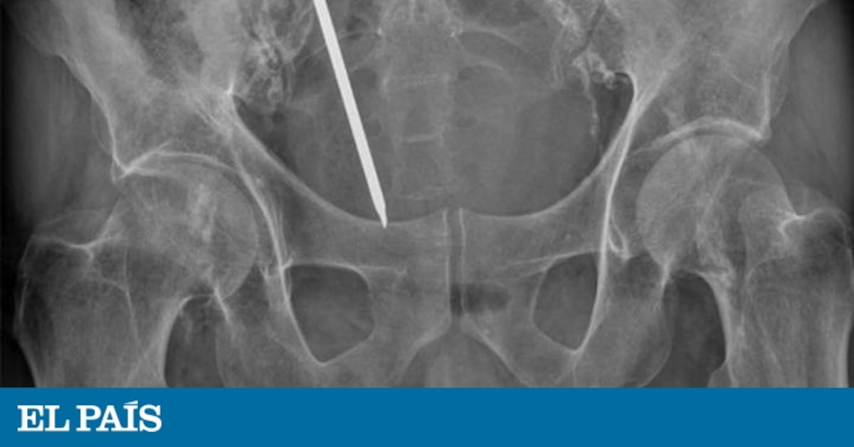 O último tabu médico: os objetos no reto | Ciência | EL PAÍS Brasil