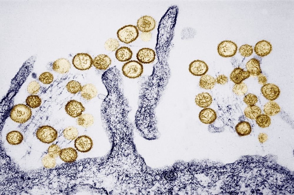 Un primer análisis genético del hantavirus del crucero confirma que es ...