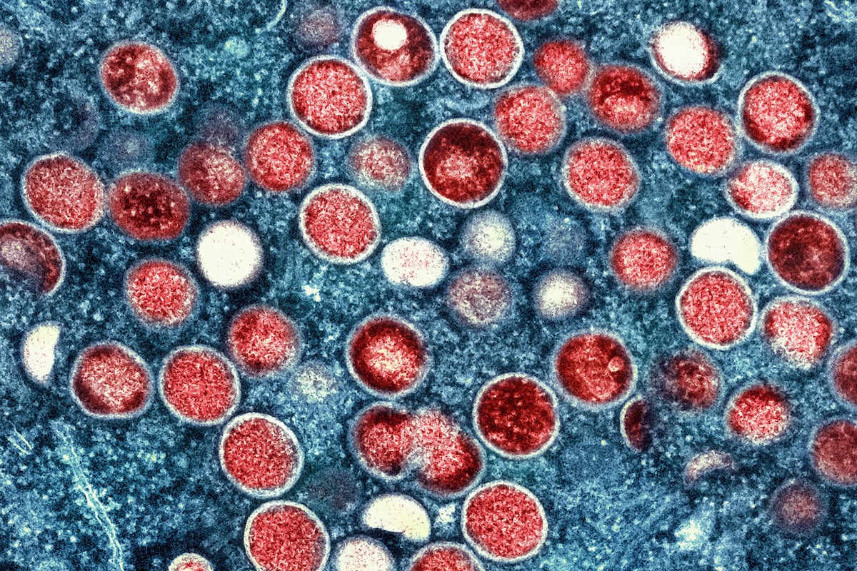 Monkeypox global health emergency: Everything you need to know | Health ...
