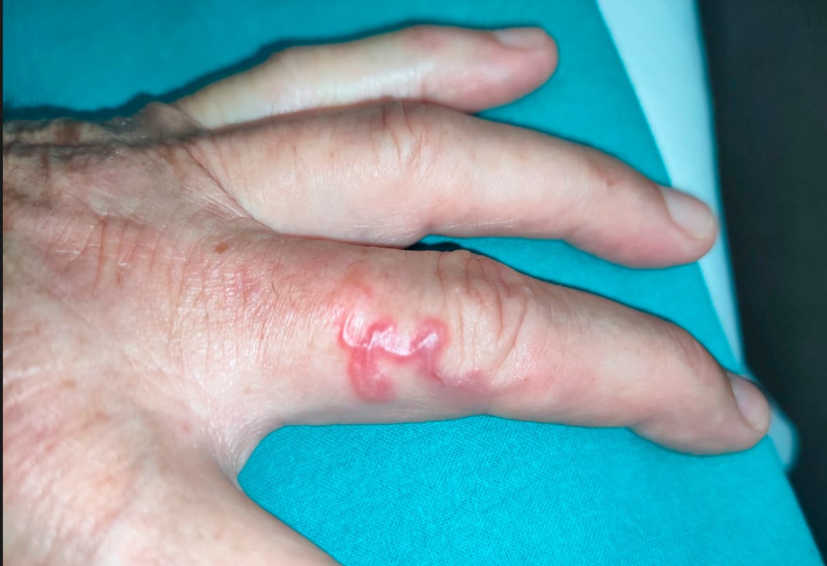 Migratory larva: An intestinal parasite in dogs and cats that also goes ...