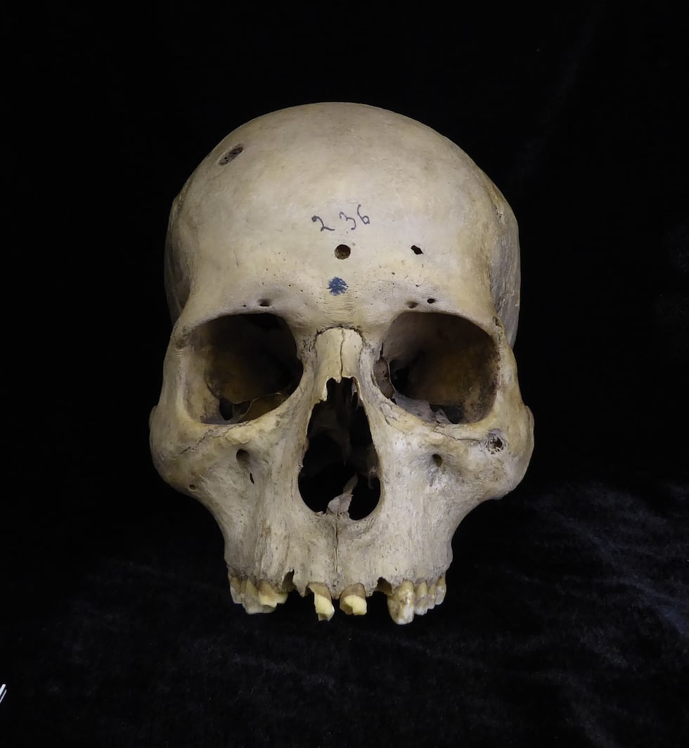 Researchers discover evidence of cancer surgery in skull from Ancient ...