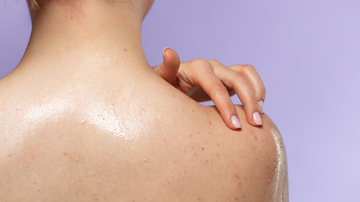 Azelaic Active Body Treatment: ¿Acné en el pecho o la espalda? Este ...