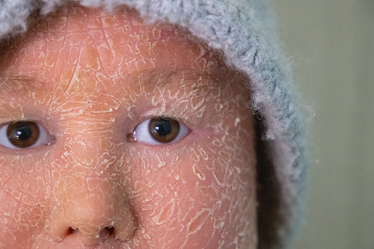 What is harlequin-type ichthyosis, the strange ‘fish skin’ disease ...