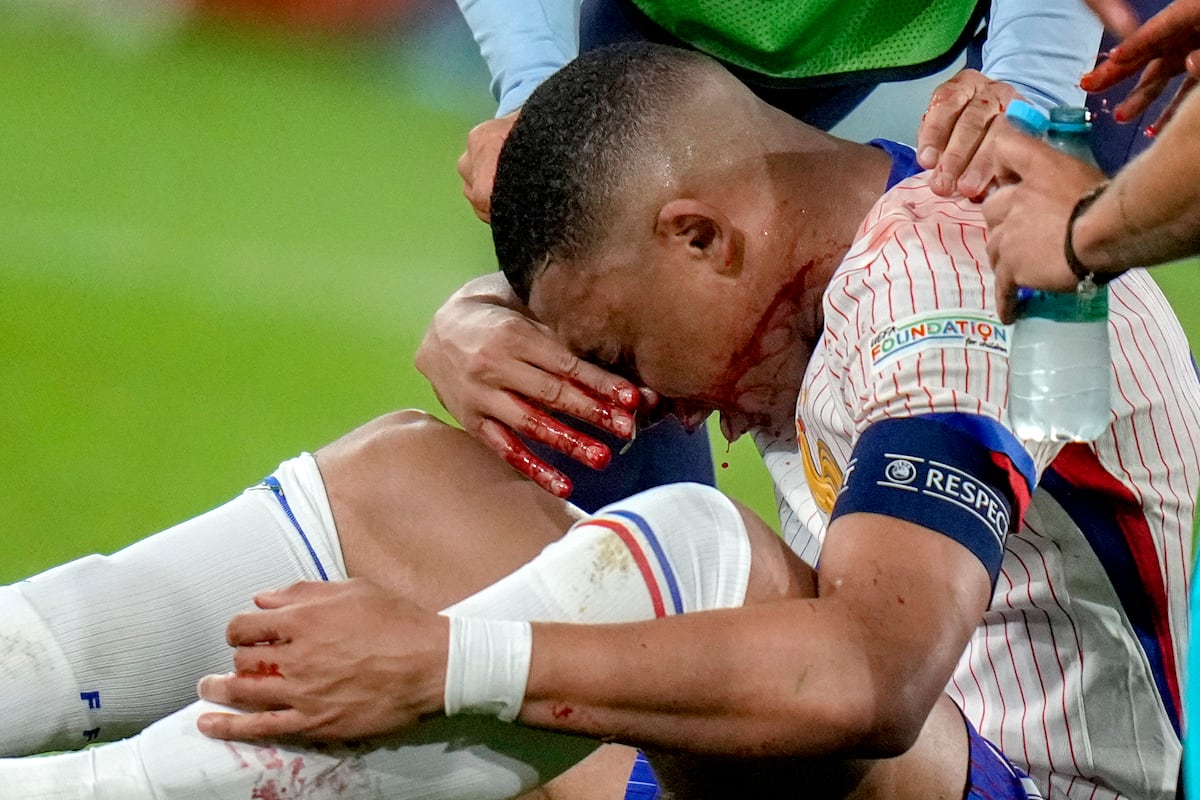 Kylian Mbappé sufre una fractura de nariz, pero se descarta la ...
