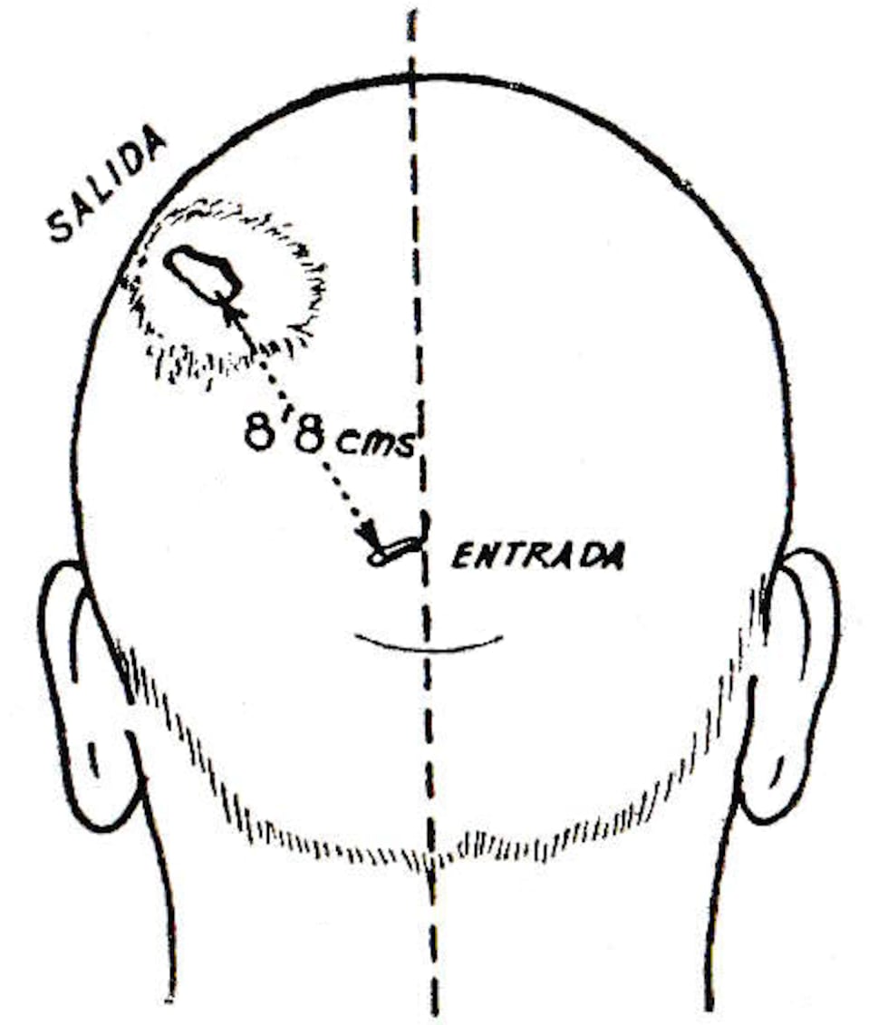 Patient M: The man who started seeing the world backwards after being ...
