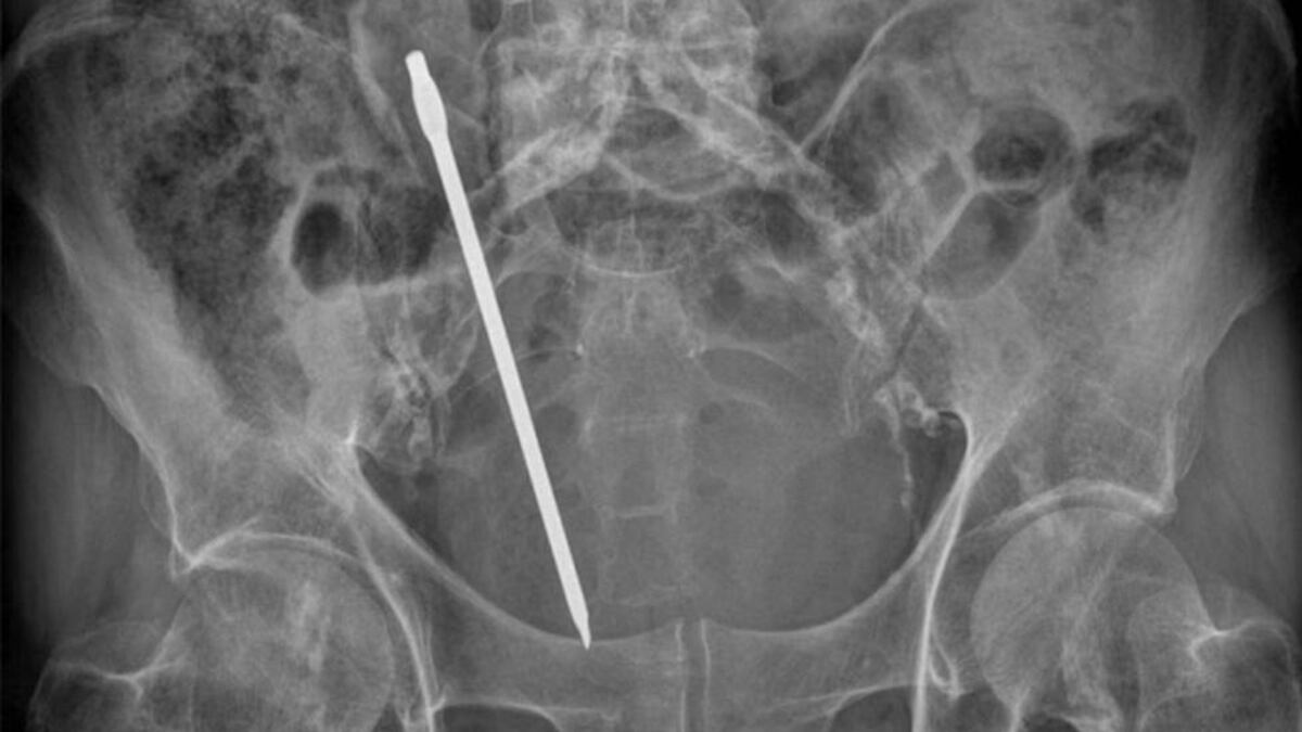El último tabú médico: los cuerpos extraños en el recto | Ciencia | EL PAÍS